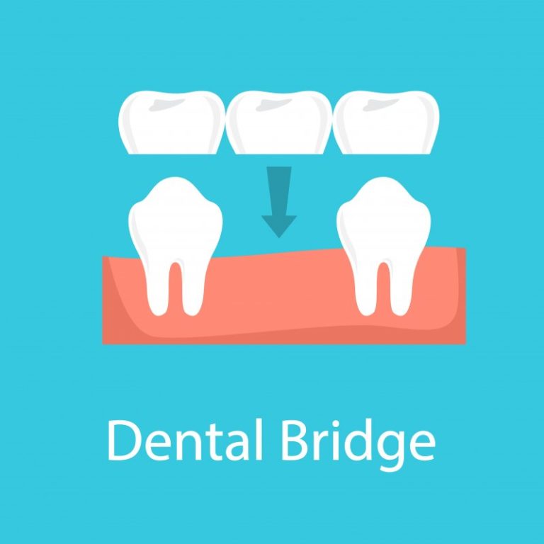 The Difference Between Partial Dentures & Dental Bridges | Alison Garrad